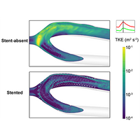 Mitigation of the turbulence within an arteriovenous fistula with a ...