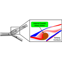 Vortex dynamics in healthy and pro-atherogenic carotid artery ...